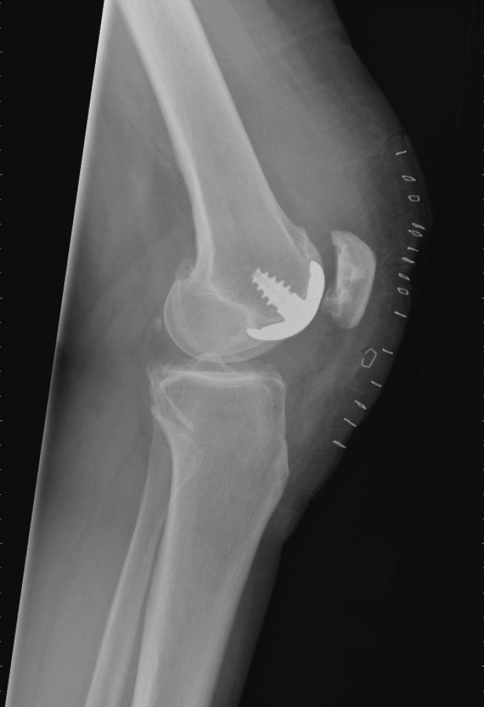 Implantes patelofemorales – Tempomedical